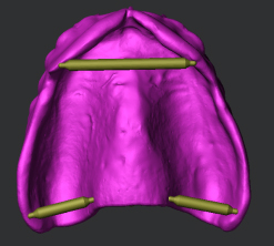 NextDent Denture 3D+