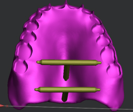 NextDent Denture 3D+