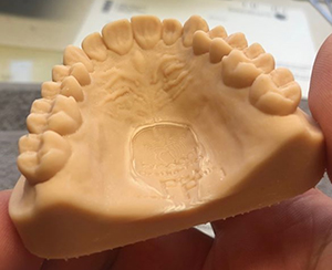 NextDent Model 2.0 Cupping