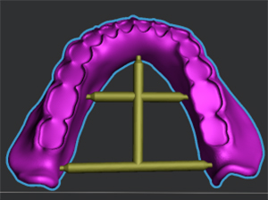 NextDent Denture 3D+