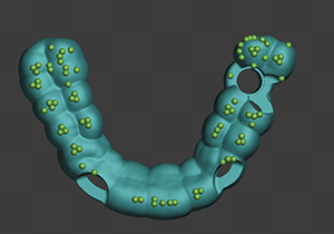 NextDent Surgical Guide