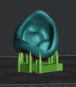 Crowntec for NextDent